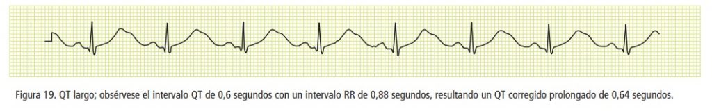 Realización e interpretación básica de un electrocardiograma - Soy Medicina