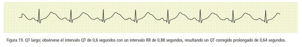 Realización e interpretación básica de un electrocardiograma - Soy Medicina