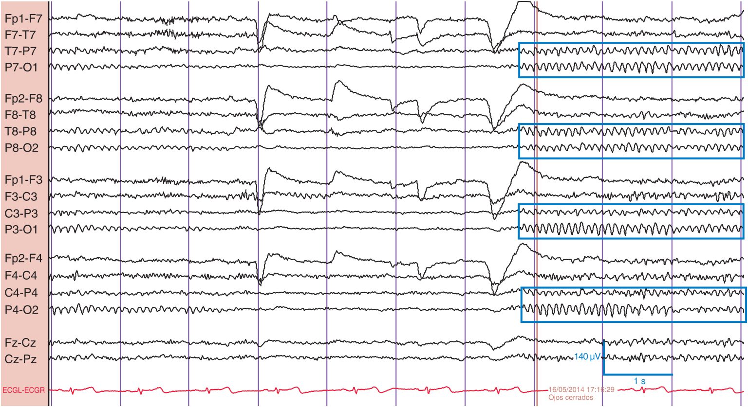 Electroencefalograma normal del adulto - Soy Medicina