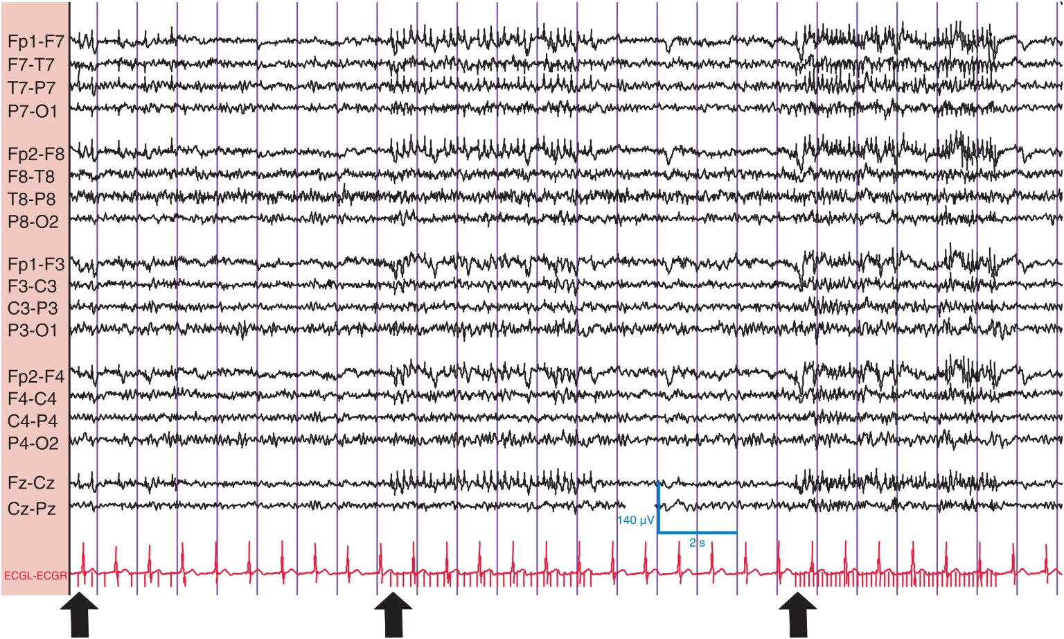 Electroencefalograma normal del adulto - Soy Medicina