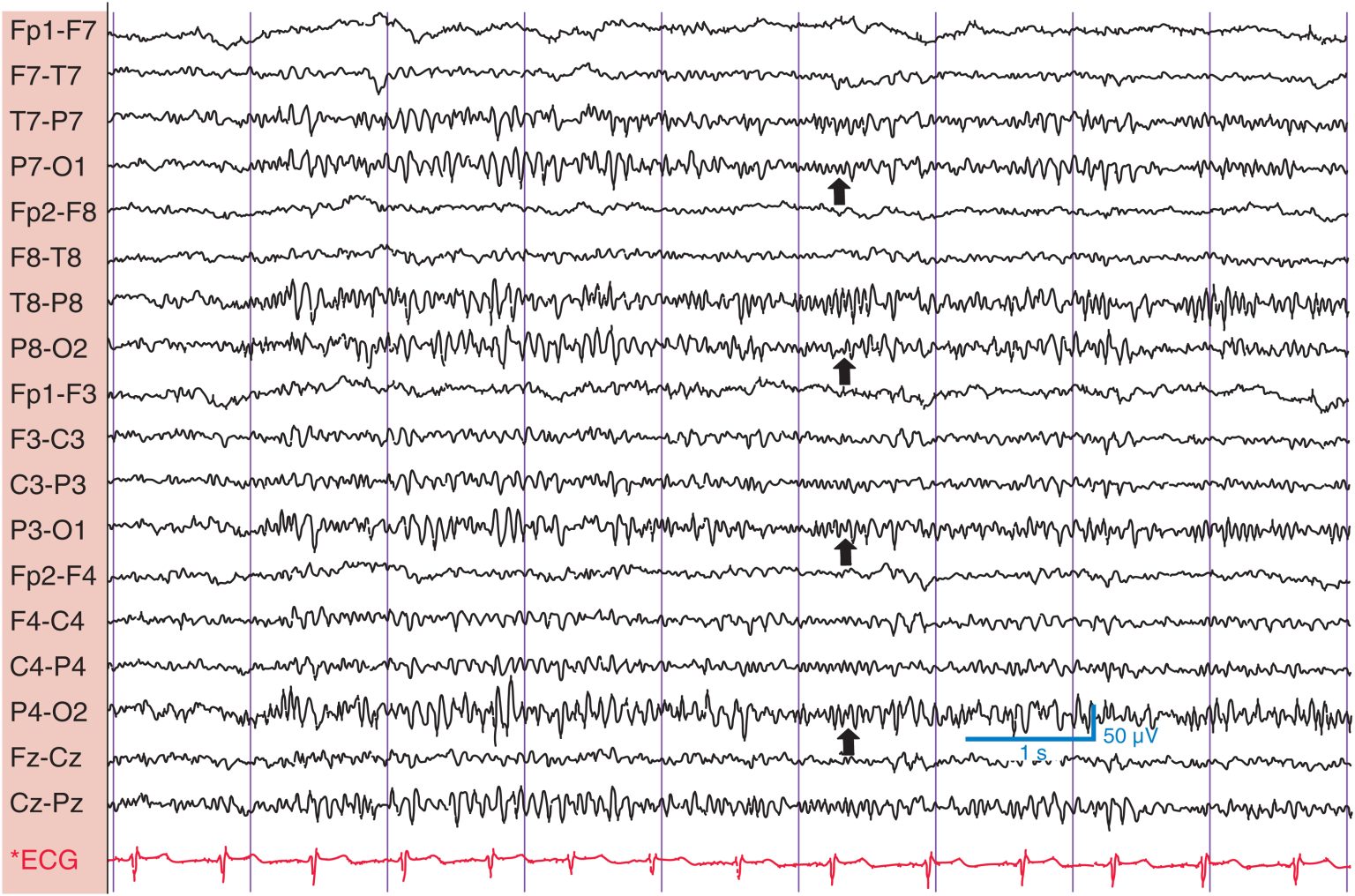 Electroencefalograma normal del adulto - Soy Medicina