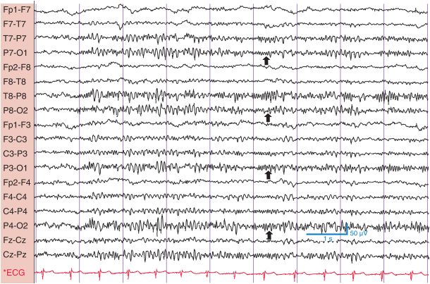 Electroencefalograma normal del adulto - Soy Medicina
