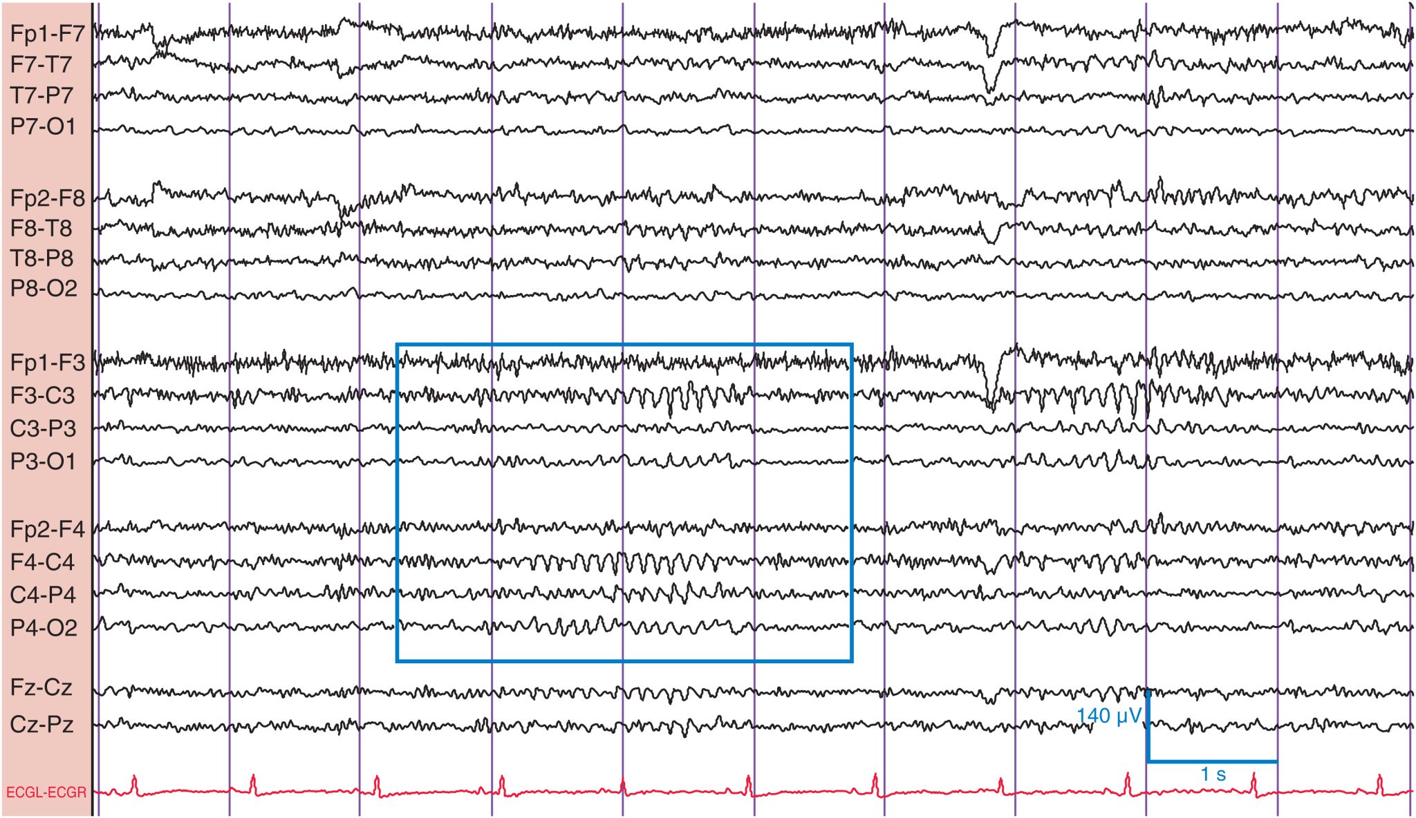 Electroencefalograma normal del adulto - Soy Medicina