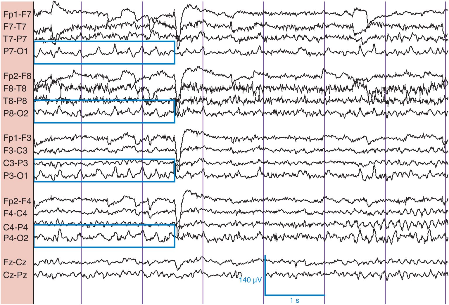 Electroencefalograma normal del adulto - Soy Medicina