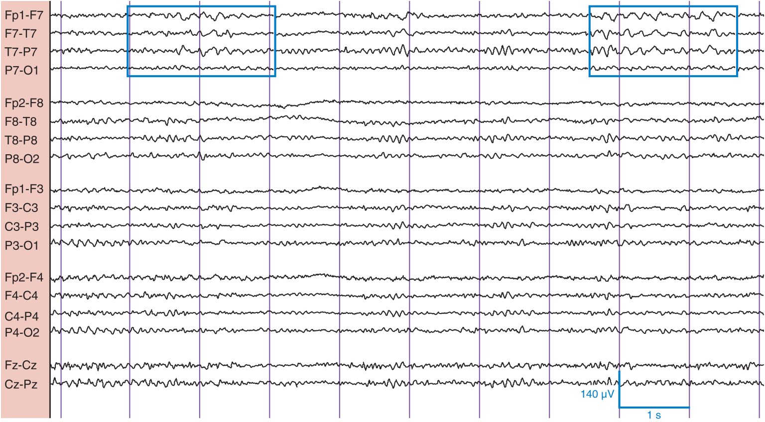 Electroencefalograma normal del adulto - Soy Medicina