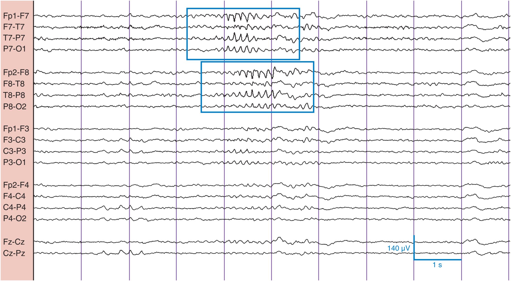 Electroencefalograma normal del adulto - Soy Medicina