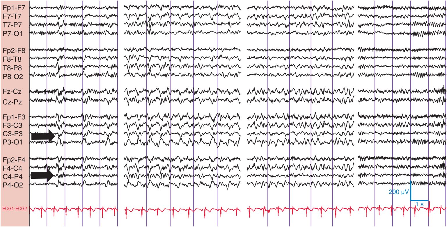 Electroencefalograma normal del adulto - Soy Medicina