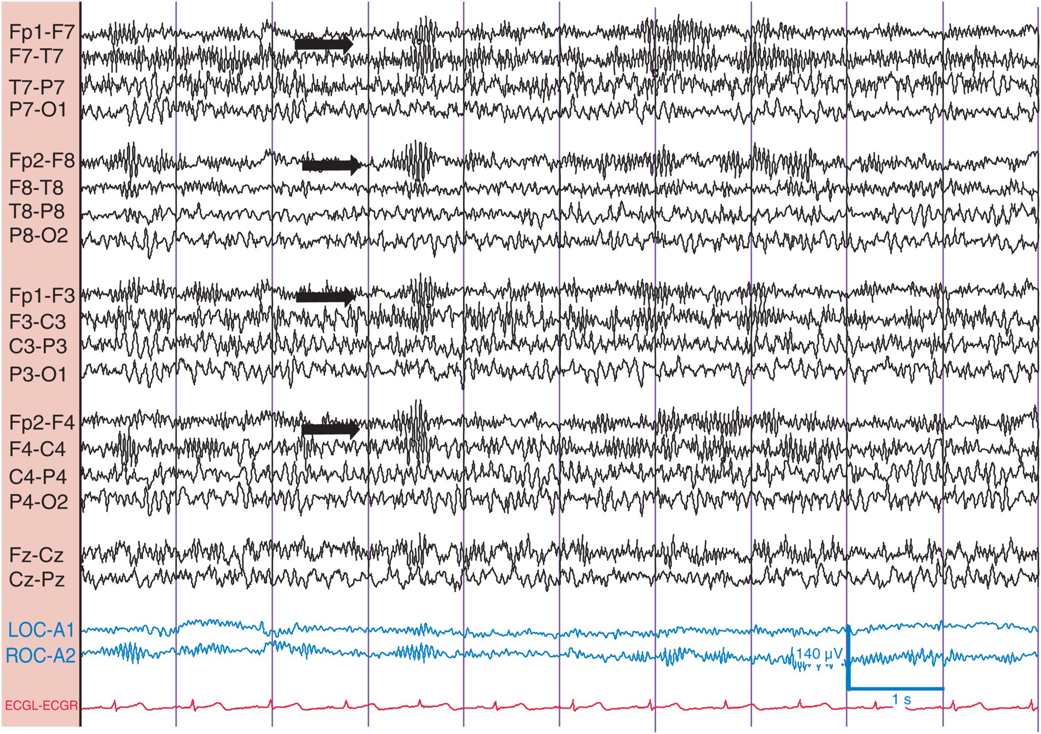 Electroencefalograma normal del adulto - Soy Medicina