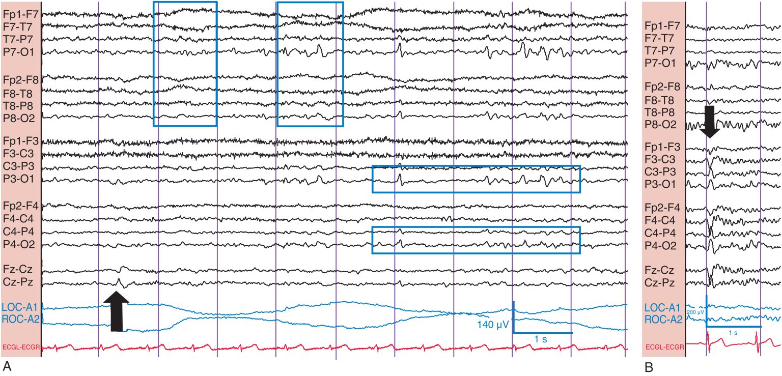 Electroencefalograma normal del adulto - Soy Medicina