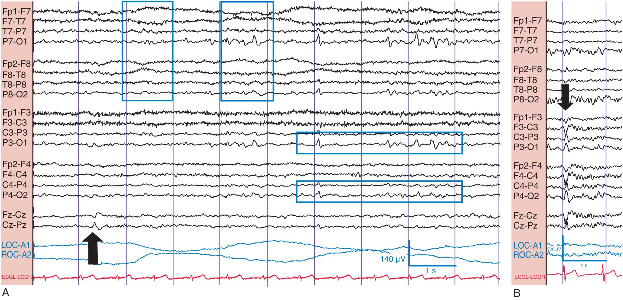 Electroencefalograma normal del adulto - Soy Medicina