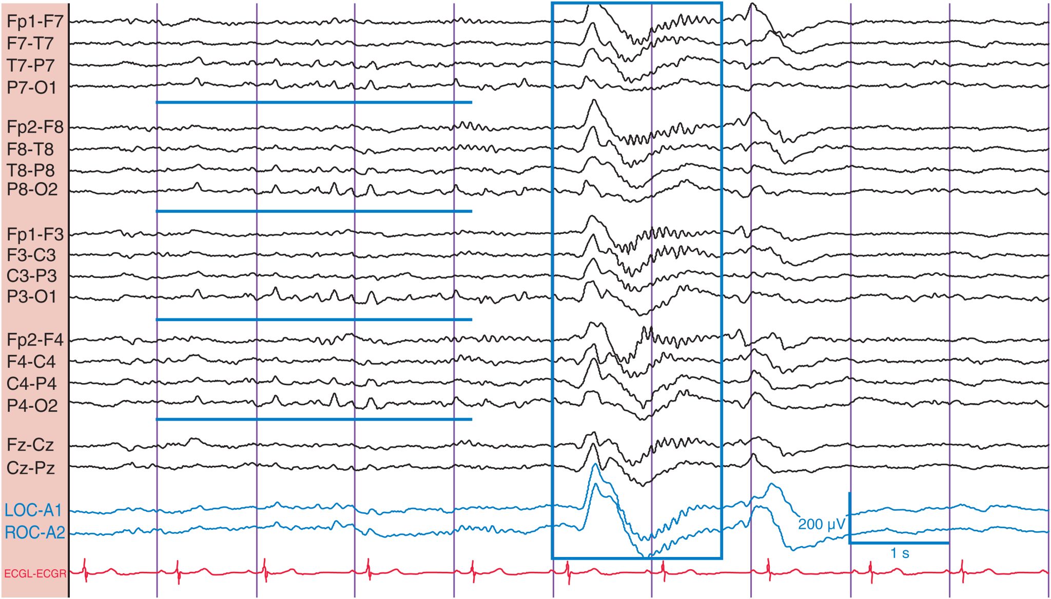 Electroencefalograma normal del adulto - Soy Medicina