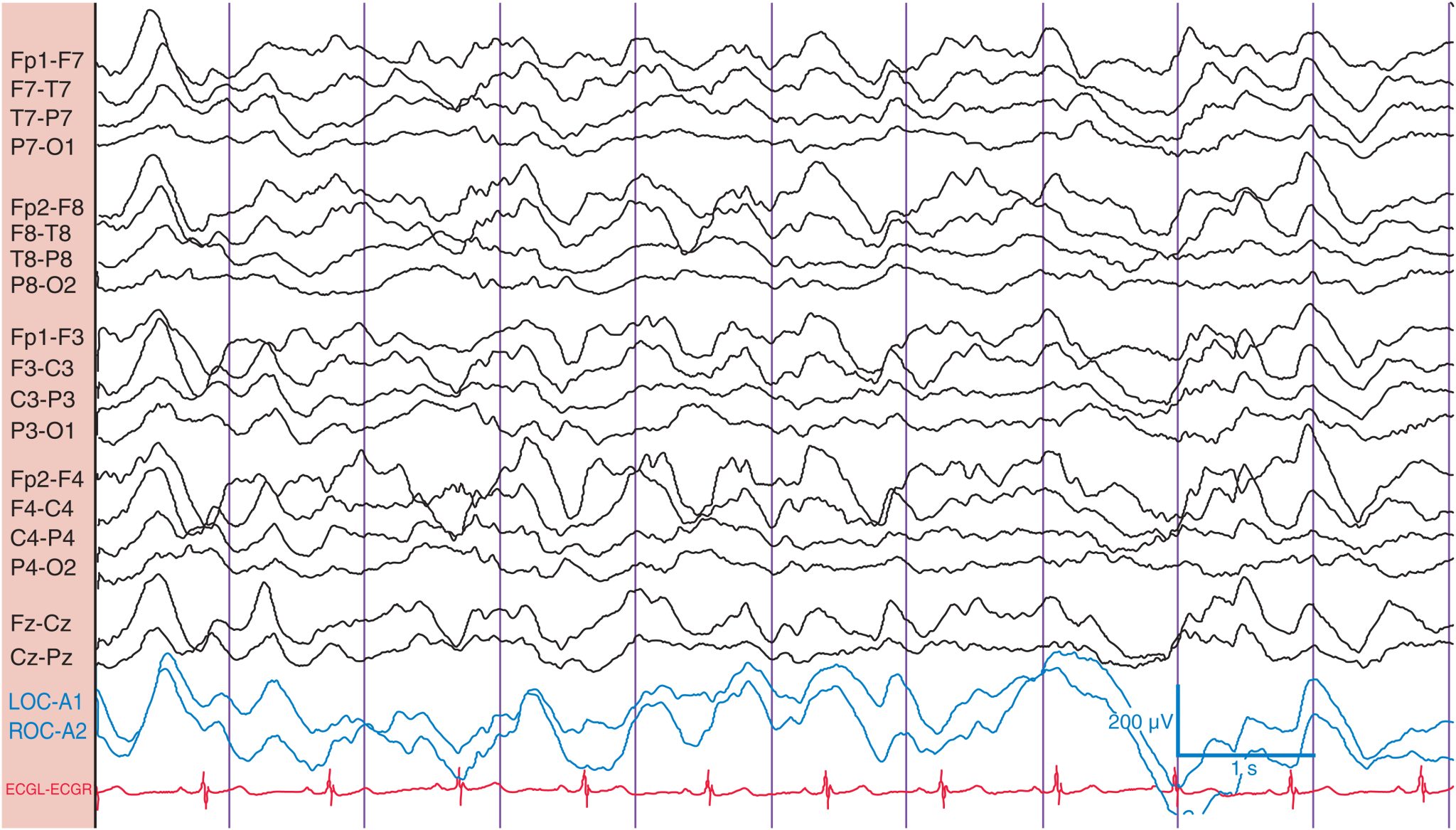 Electroencefalograma normal del adulto - Soy Medicina