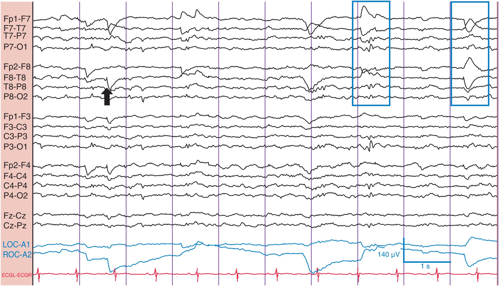 Electroencefalograma normal del adulto - Soy Medicina