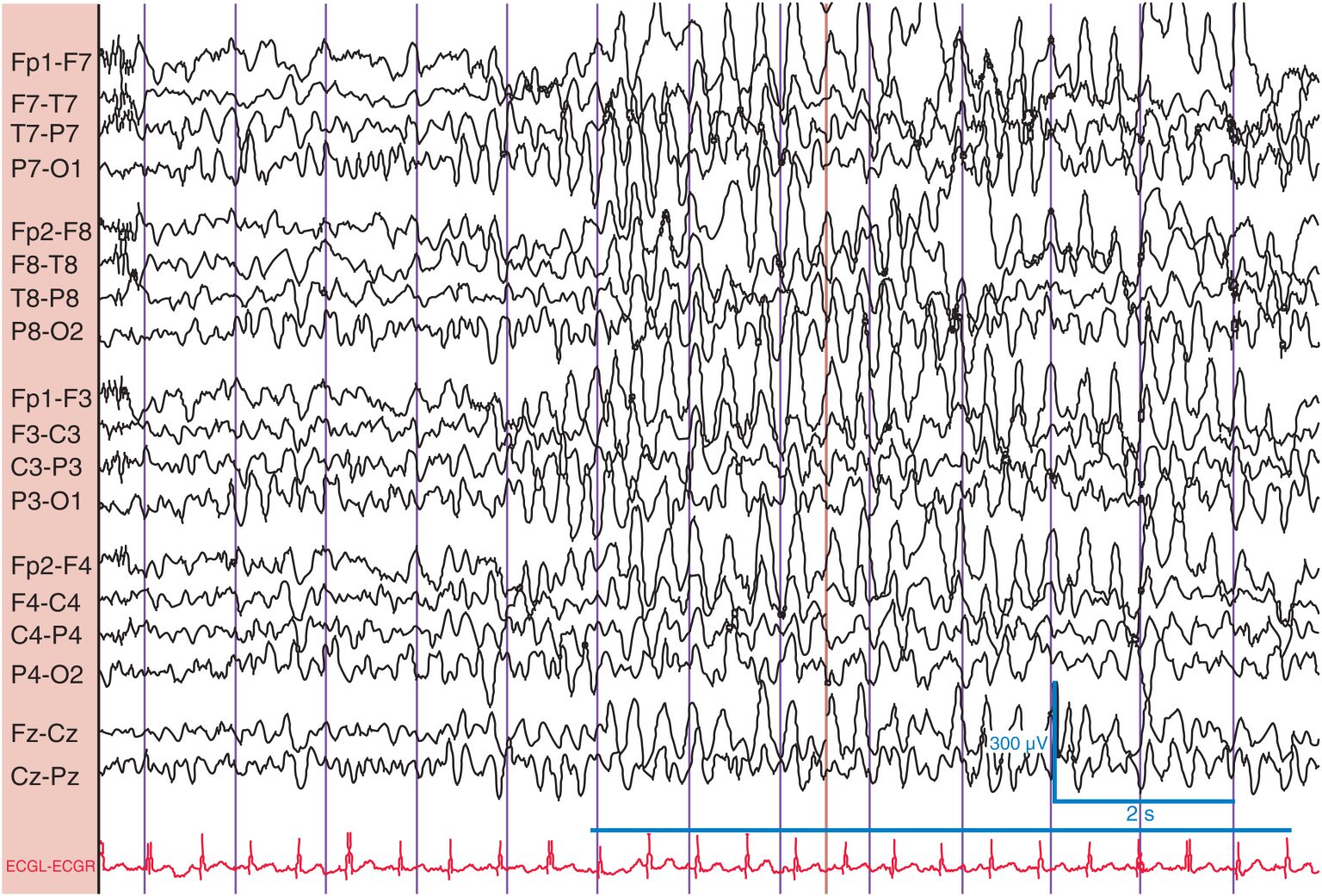 Electroencefalograma normal del adulto - Soy Medicina