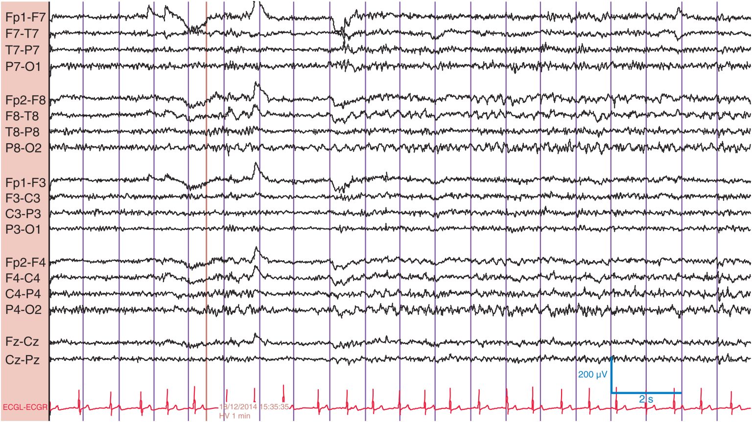 Electroencefalograma normal del adulto - Soy Medicina