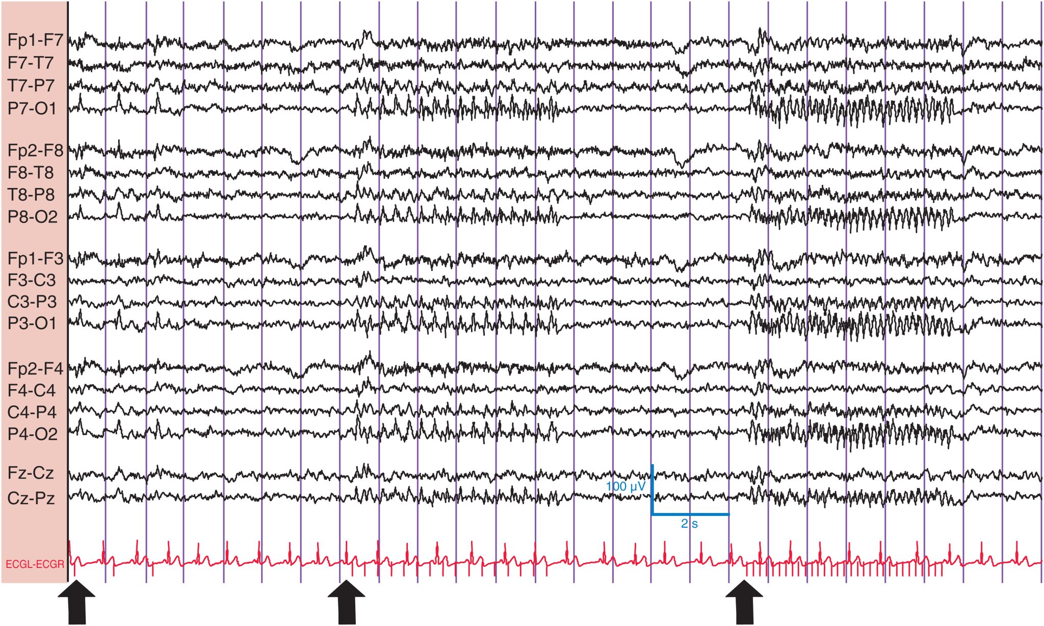 Electroencefalograma normal del adulto - Soy Medicina